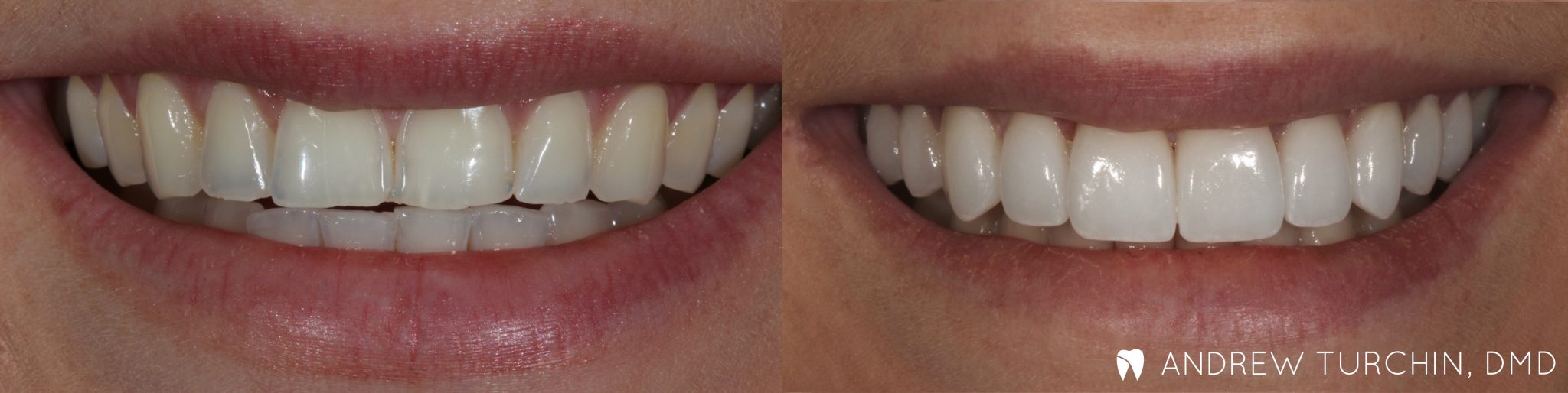 Dentist Aspen CO | Andrew Turchin | Before & After Gallery