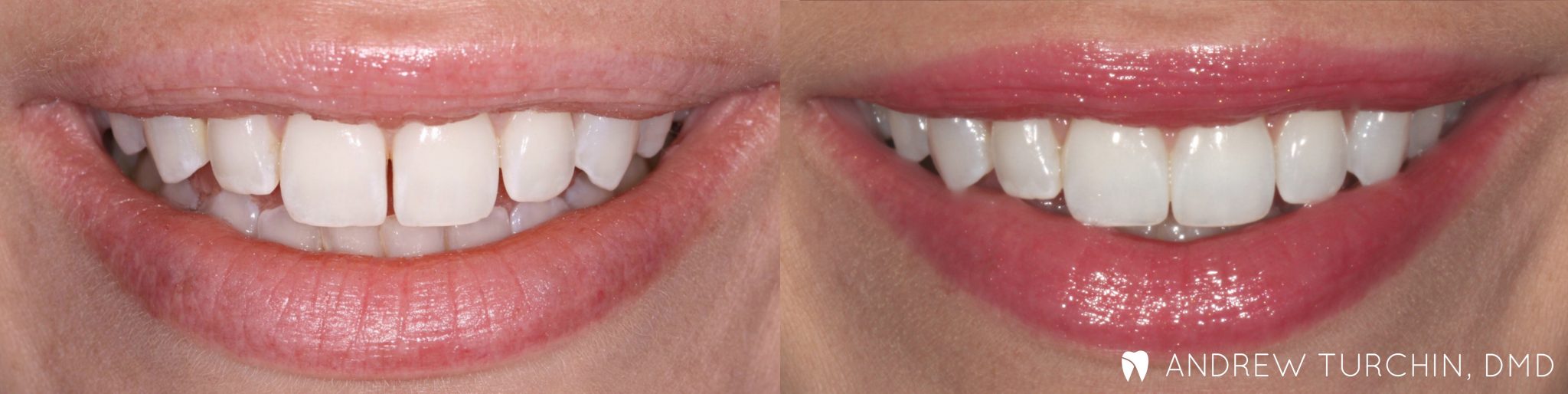 Dentist Aspen CO | Andrew Turchin | Before & After Gallery