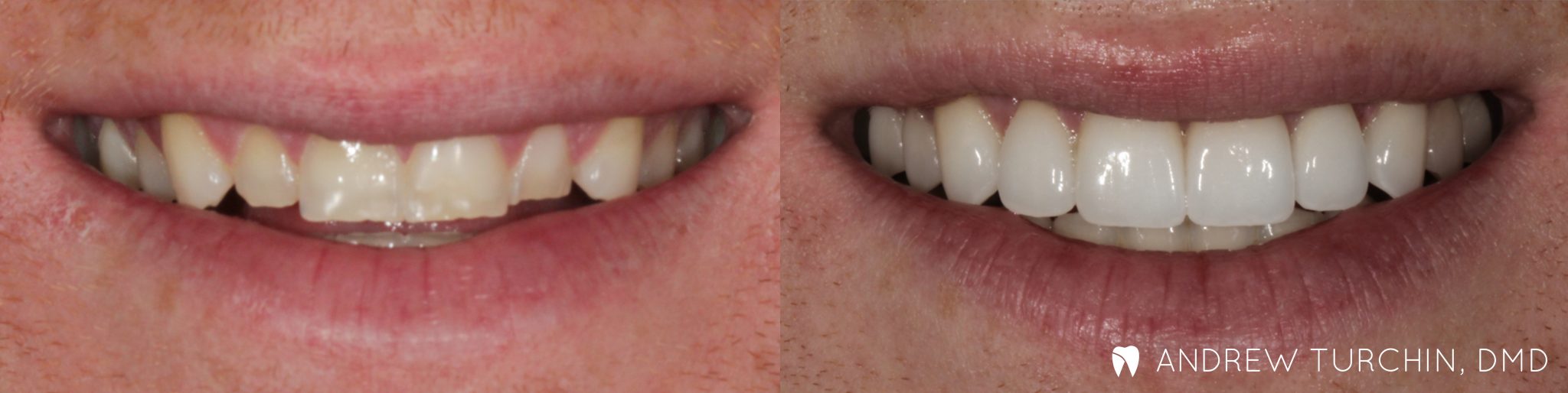 Dentist Aspen CO | Andrew Turchin | Before & After Gallery