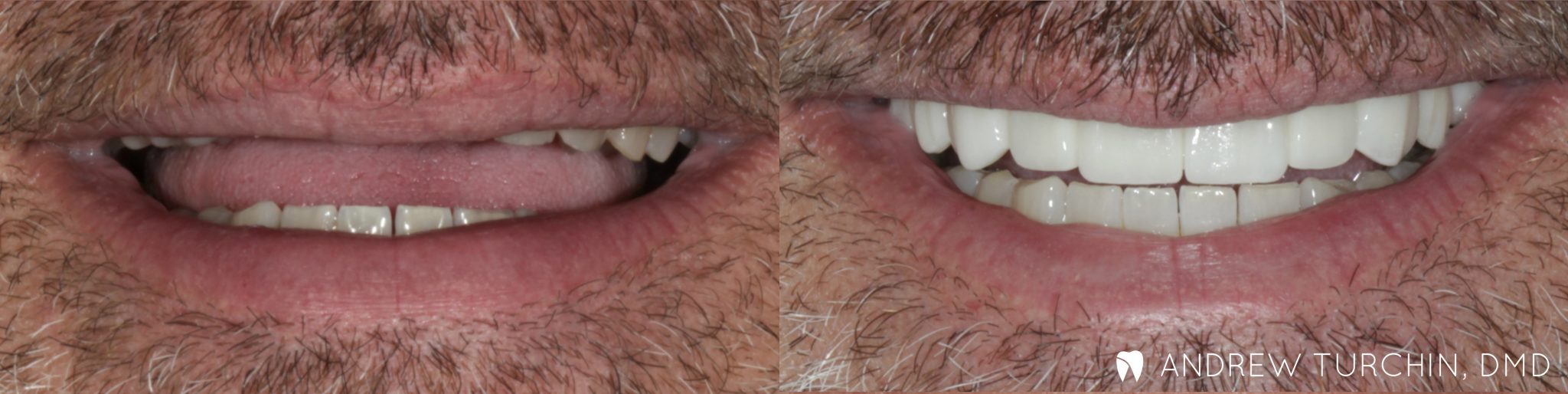 Dentist Aspen CO | Andrew Turchin | Before & After Gallery