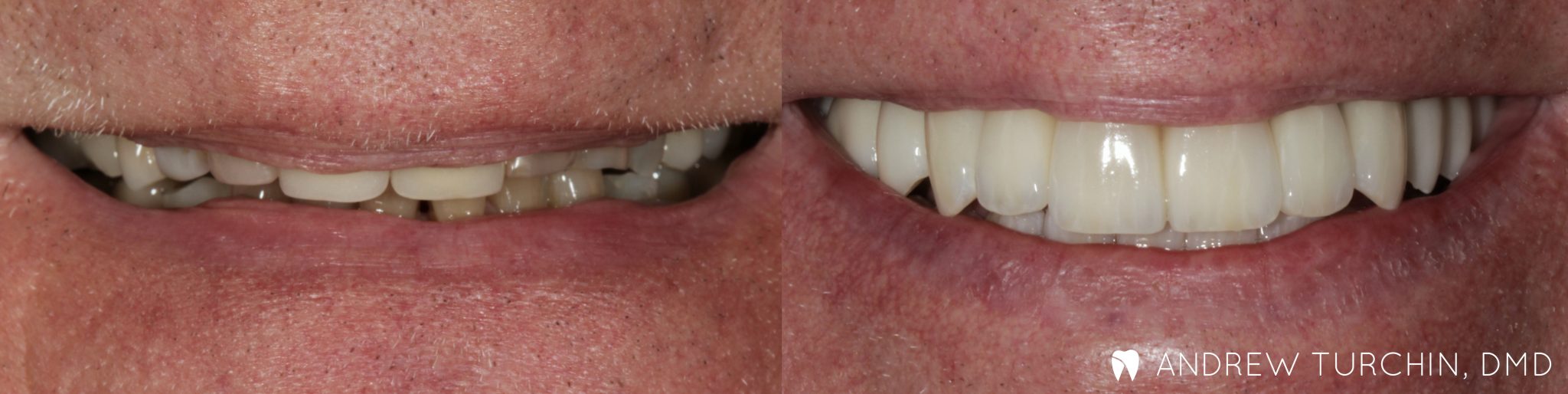 Dentist Aspen CO | Andrew Turchin | Before & After Gallery