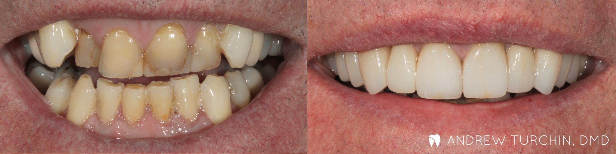 Dentist Aspen CO | Andrew Turchin | Before & After Gallery