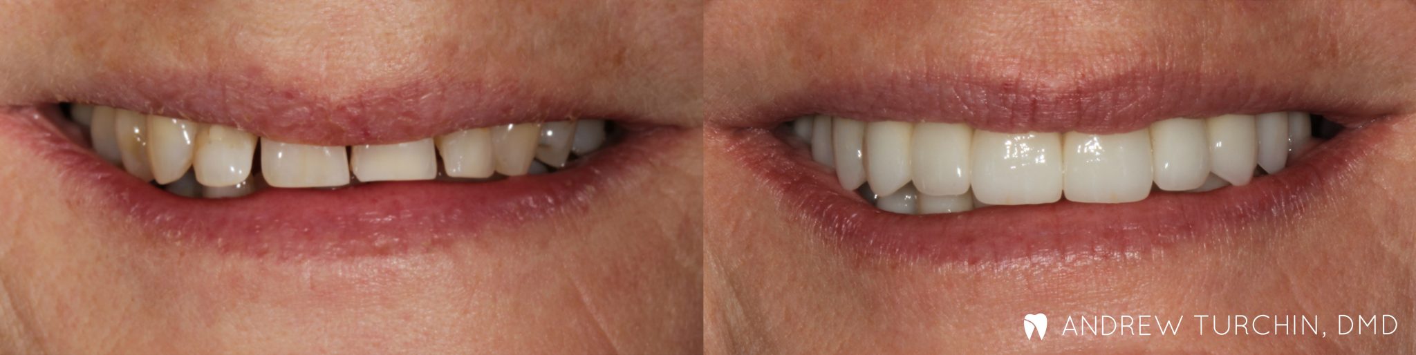 Dentist Aspen CO | Andrew Turchin | Before & After Gallery