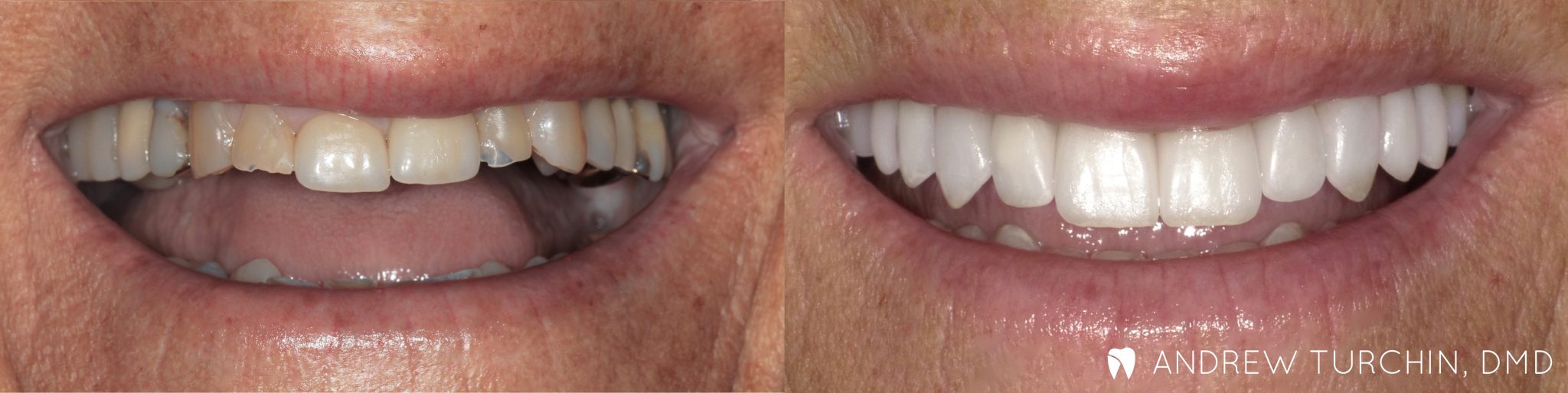 Dentist Aspen CO | Andrew Turchin | Before & After Gallery