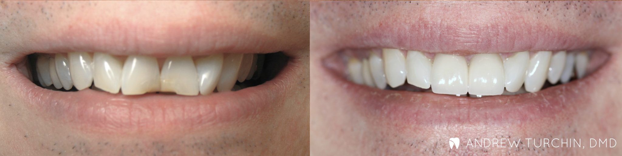 Dentist Aspen CO | Andrew Turchin | Before & After Gallery